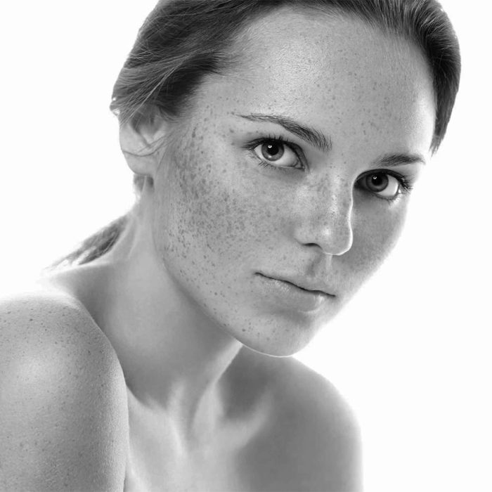 Hyperpigmentation Treatment Toronto For An Even Skin Tone